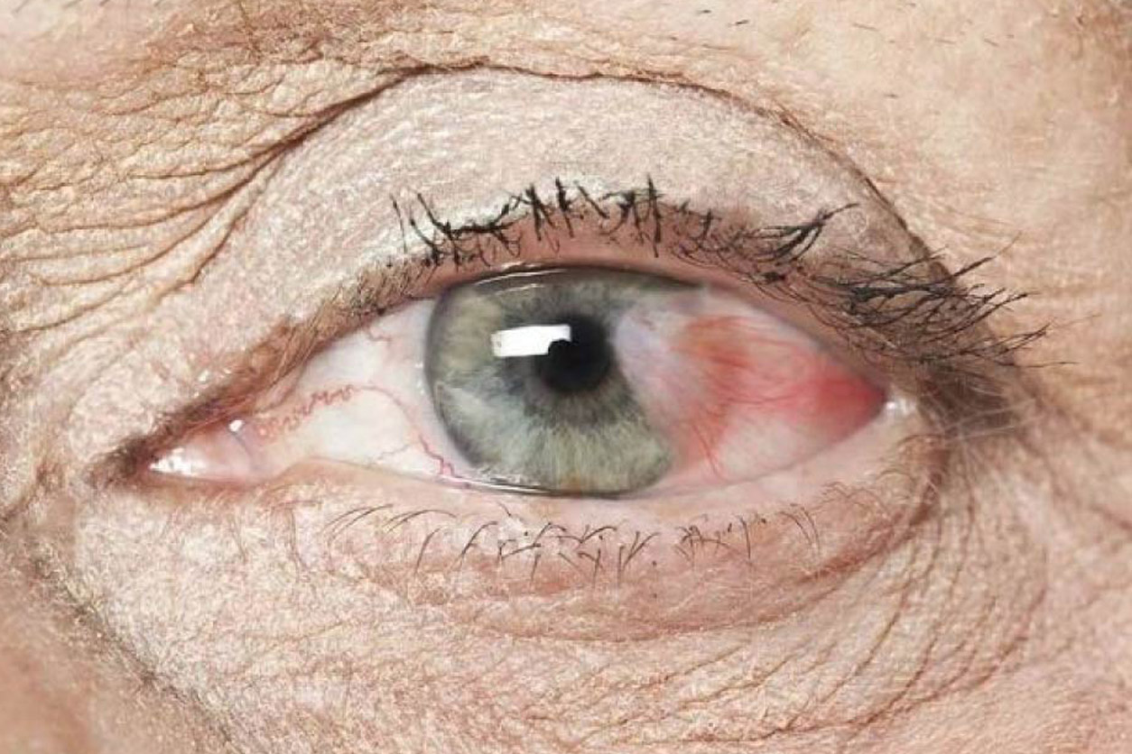 Cirurgia de pterigio - Visu Clinic